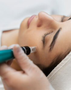 Mesotherapy Treatment in North York & Mississauga - Alyssum Cosmetic Clinic