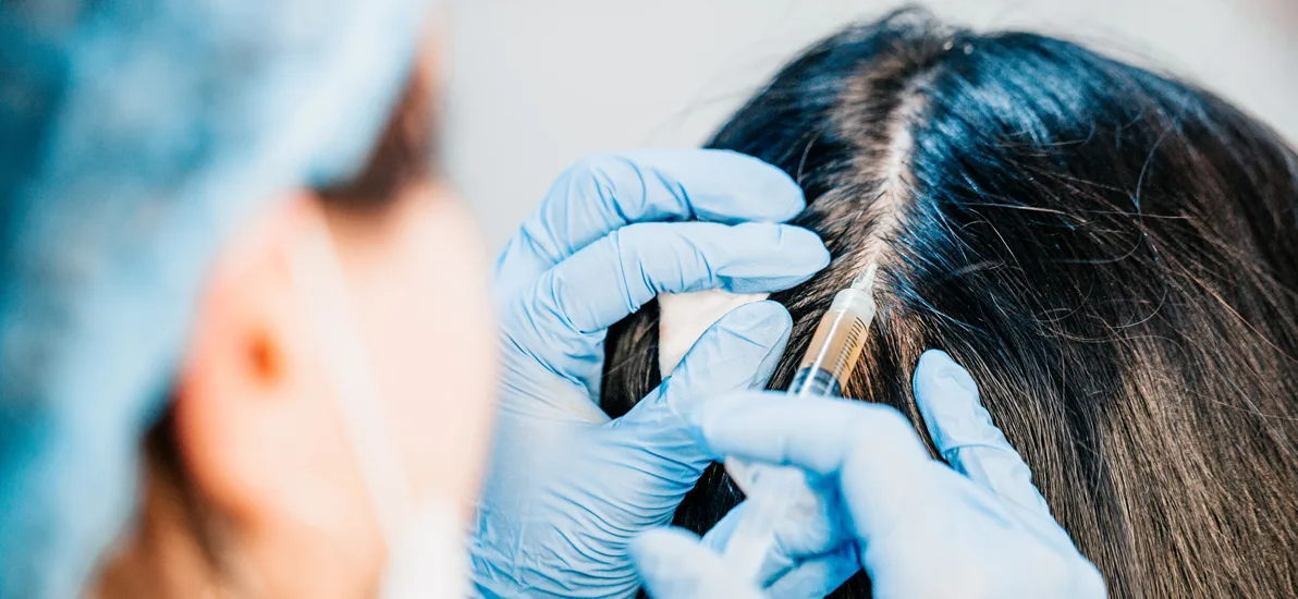 Understanding PRP Hair Restoration: A Step-by-Step Guide to the ...